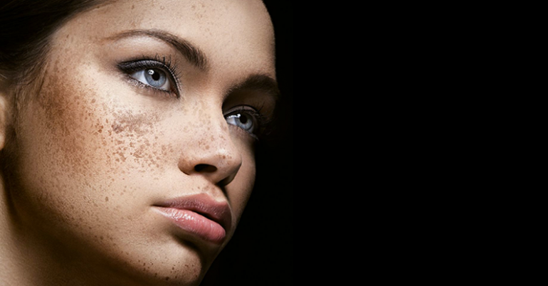 Les taches brunes ou hyperpigmentation de la peau. - Actu Santé Fenua