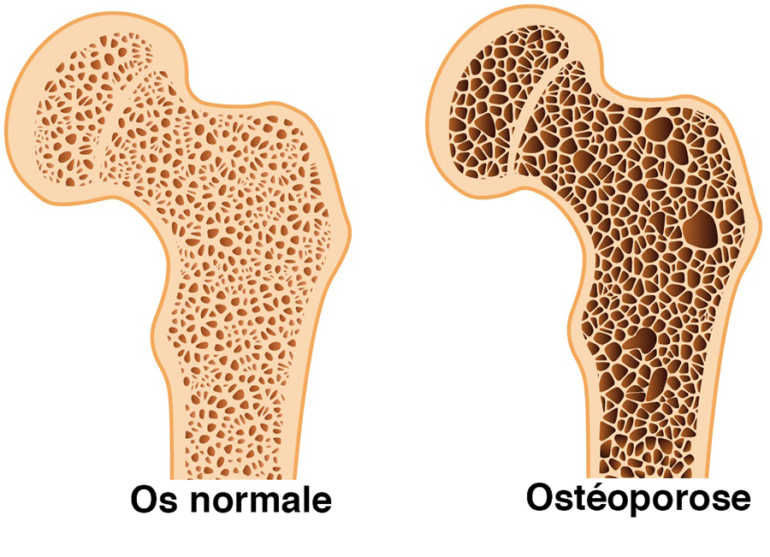Comprendre l'ostéoporose pour mieux préserver son capital osseux - Actu ...